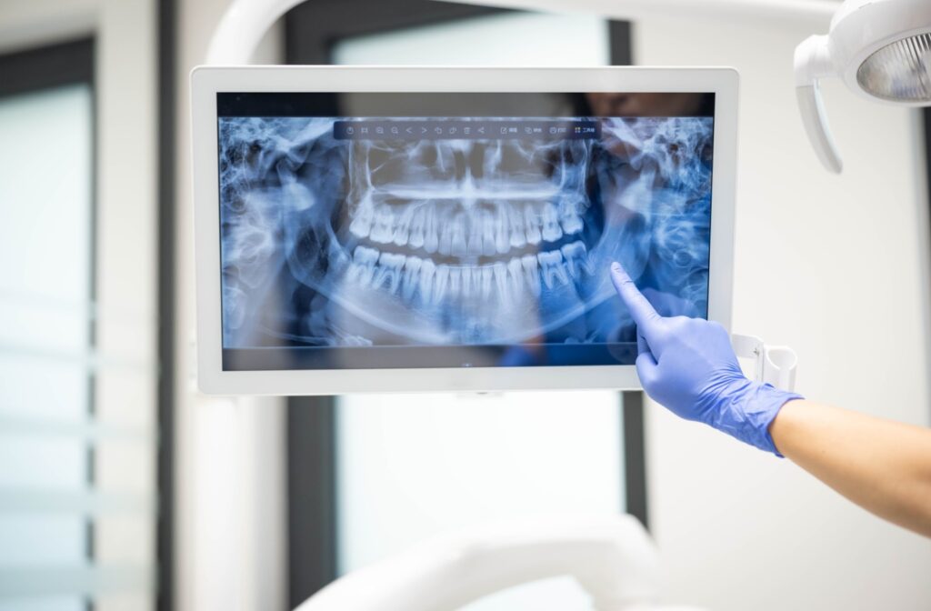 What Is a Dental Recall Exam? | Acacia Dental Centre